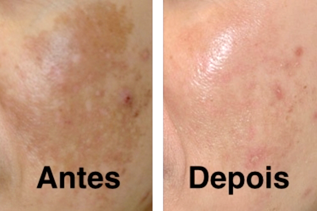 Dicas para acabar com melasma no rosto - Dermatologista Especialista