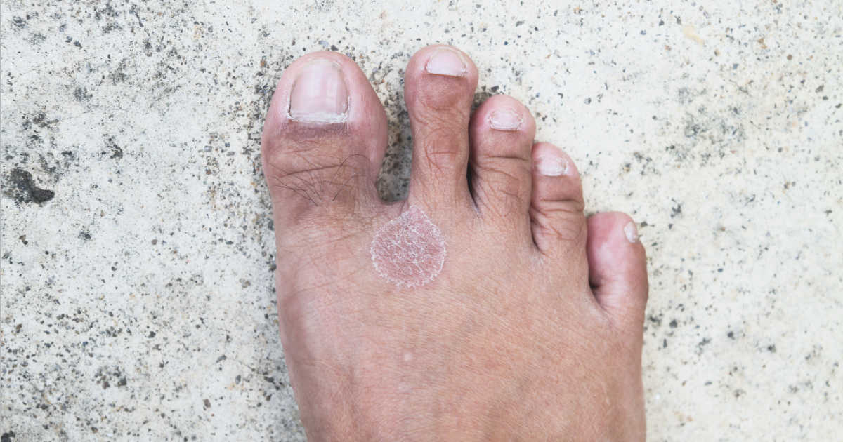 Conheça sobre o impingem - Dermatologista Especialista